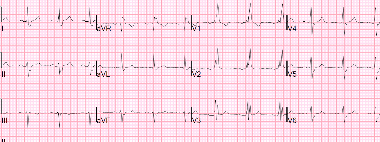 Dr Smith s ECG Blog Right Bundle Branch Block What Else dr-smith-s-ecg-blog-right-bundle-branch-block-what-else