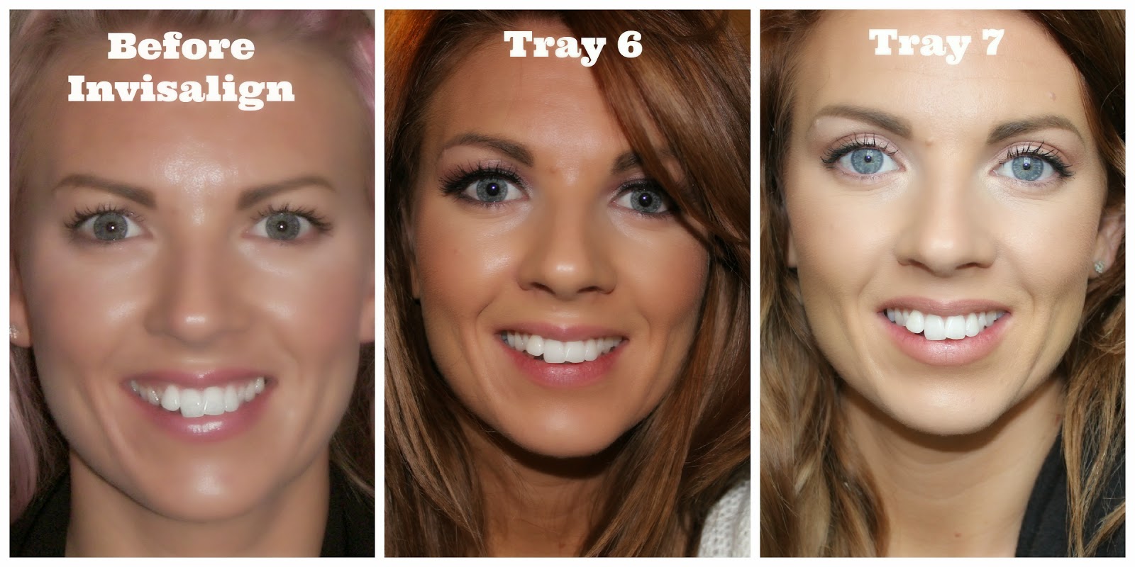 What Do I Look Like With Braces what-do-i-look-like-with-braces