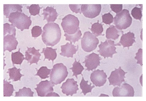 Atlas de Hematología : Acantocitos.