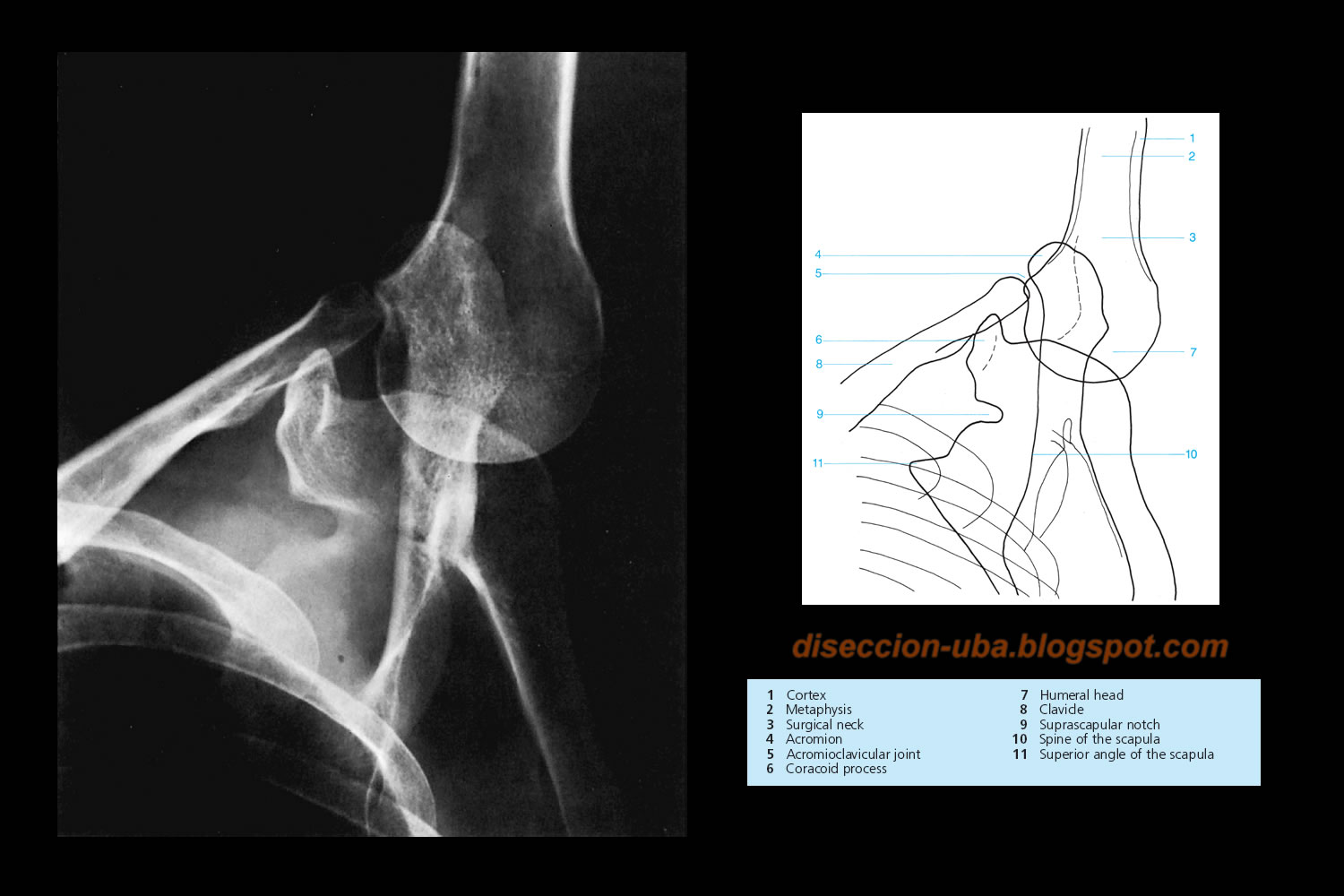 rx: Rx hombro anteroposterior en abducción máxima