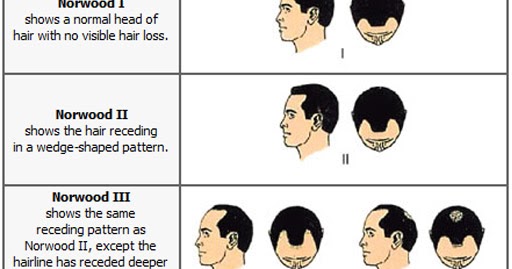 Cure against baldness: Norwood-Hamilton Scale of Male Pattern Baldness