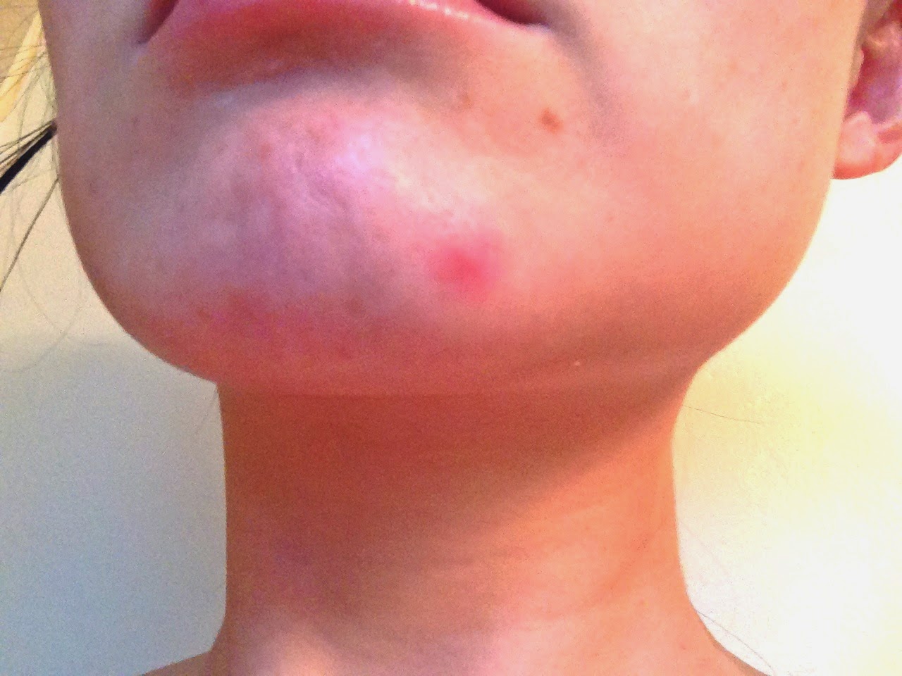 What Is Cystic Acne what-is-cystic-acne