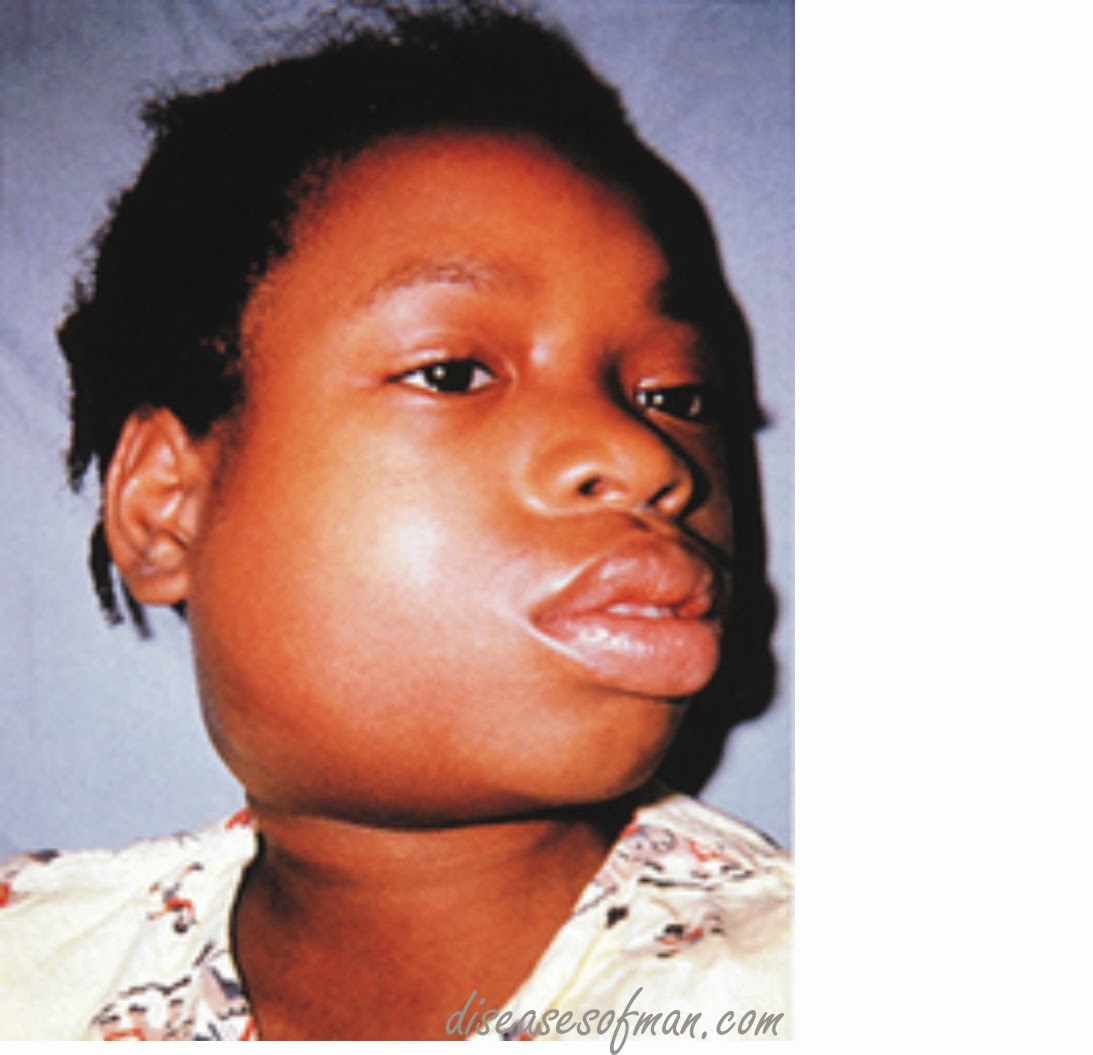 MUMPS Causes Signs And Symptoms Treatment Management And Prevention mumps-causes-signs-and-symptoms-treatment-management-and-prevention