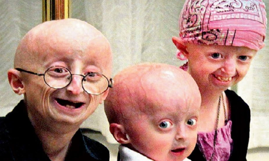NurseTecmilenio Genetic Mutations Werner Syndrome nursetecmilenio-genetic-mutations-werner-syndrome