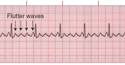 Atrial Flutter (Fluter Atrial) - JANTUNG OKE