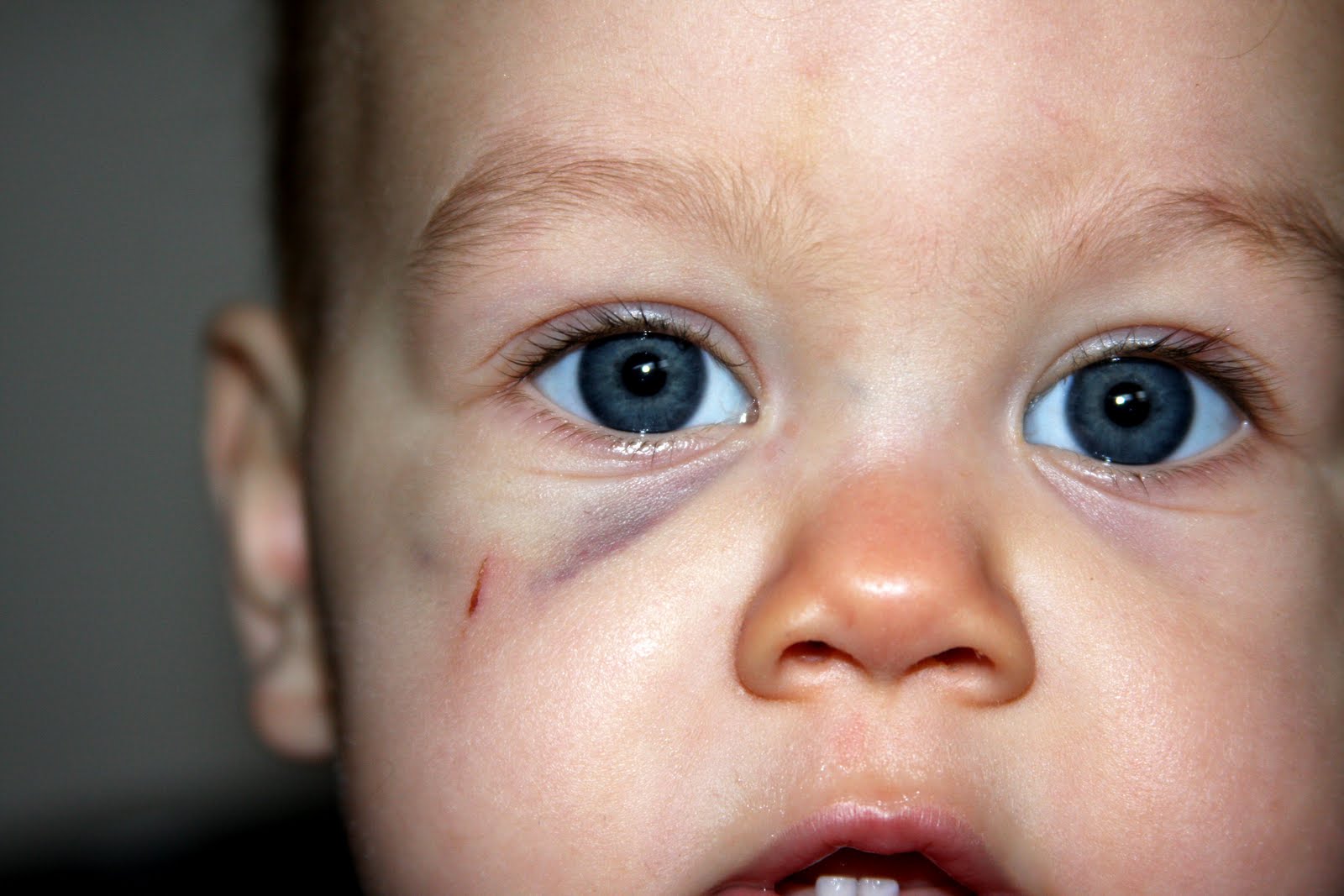 and Baby Makes FOUR First Black Eye and-baby-makes-four-first-black-eye