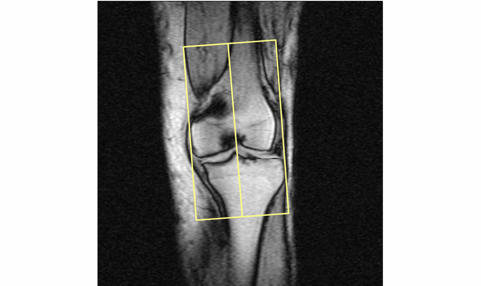 Protocolo de Rodilla por RM