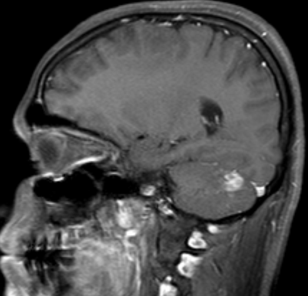 Dengue Hemorrhagic Fever MRI Sumer s Radiology Blog dengue-hemorrhagic-fever-mri-sumer-s-radiology-blog