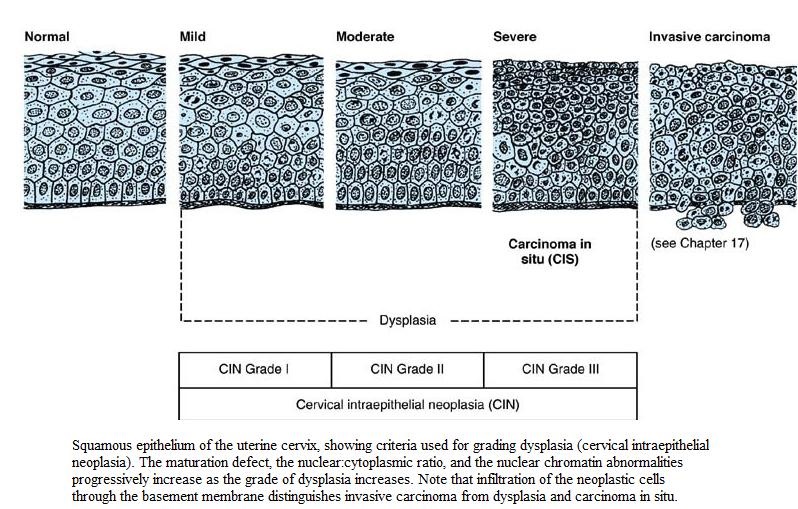 MBBS Medicine (Humanity First): Neoplasia : Differentiation and anaplasia MBBS Medicine (Humanity First): Neoplasia : Differentiation and anaplasia
