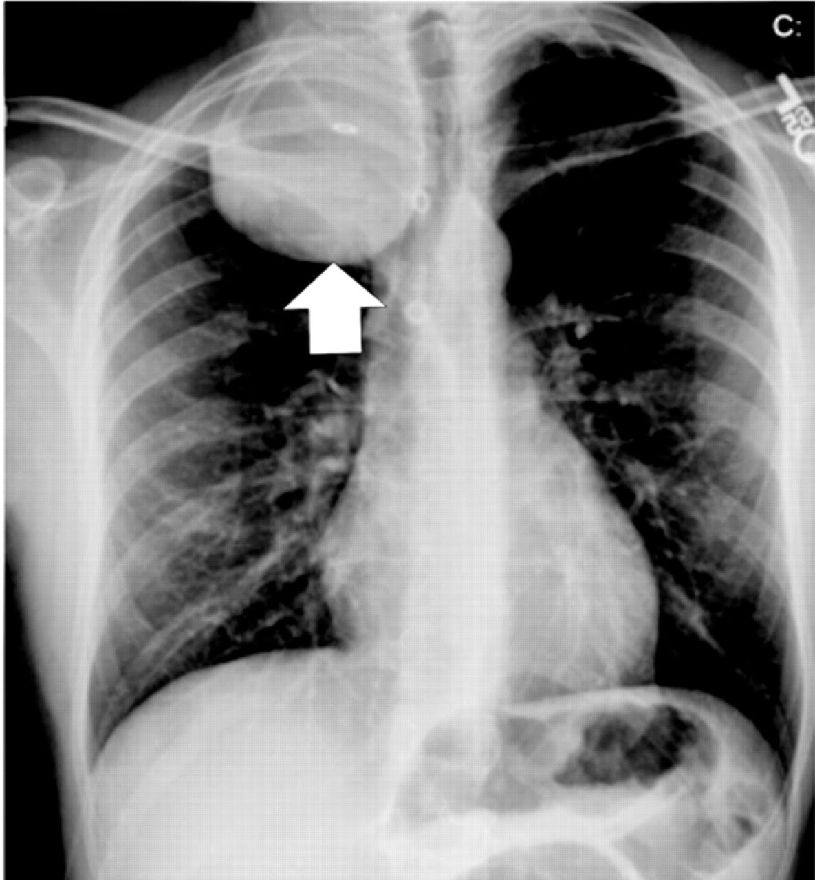 DrRattawachIR Transthoracic Needle Biopsy drrattawachir-transthoracic-needle-biopsy
