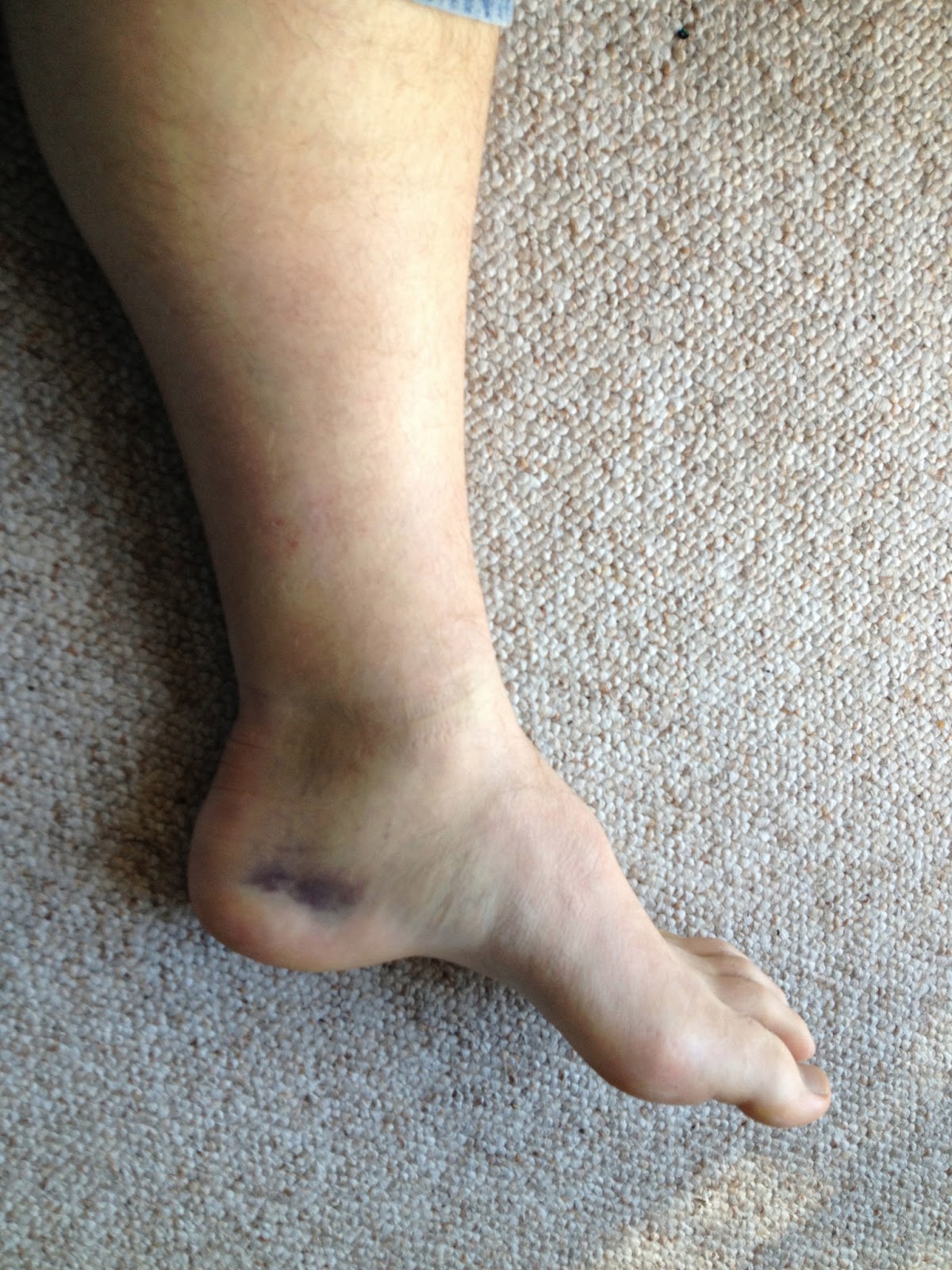 Hurt Versus Injured hurt-versus-injured