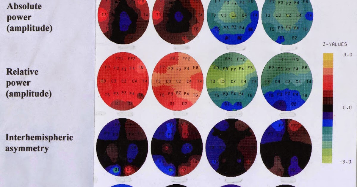 Planitikos.gr || Επιστημονική ενημέρωση: Τo εγκεφαλογράφημα