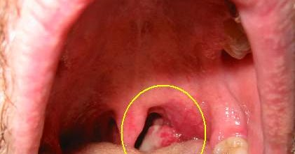 Northland Ear Nose and Throat: A new epidemic- Oral cancer due to HPV