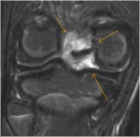 Unsual ganglion cyst in intercondylar notch in childern - Sumer's Radiology Blog