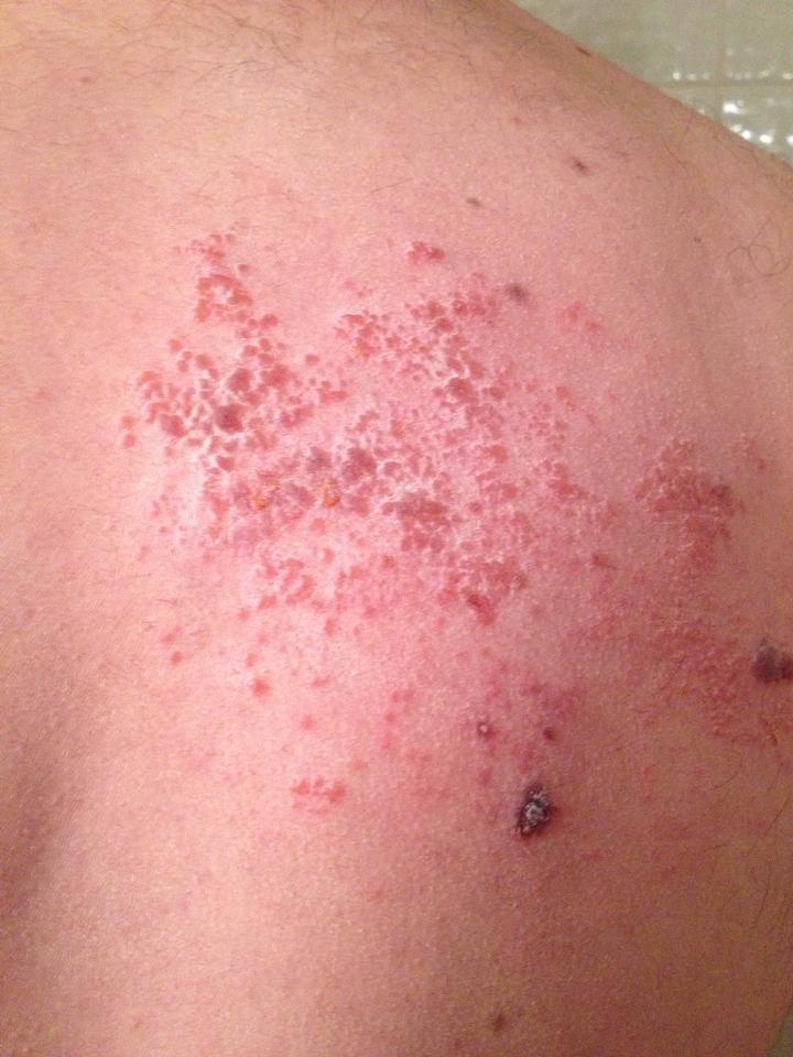 Diagnose How Do You Diagnose Shingles diagnose-how-do-you-diagnose-shingles