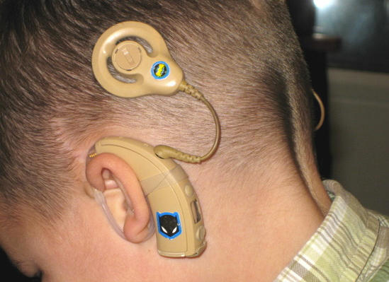 Motivated Parent Successful Child Cochlear Implant In Children motivated-parent-successful-child-cochlear-implant-in-children