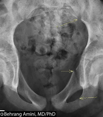 Roentgen Ray Reader: Malgaigne Fracture