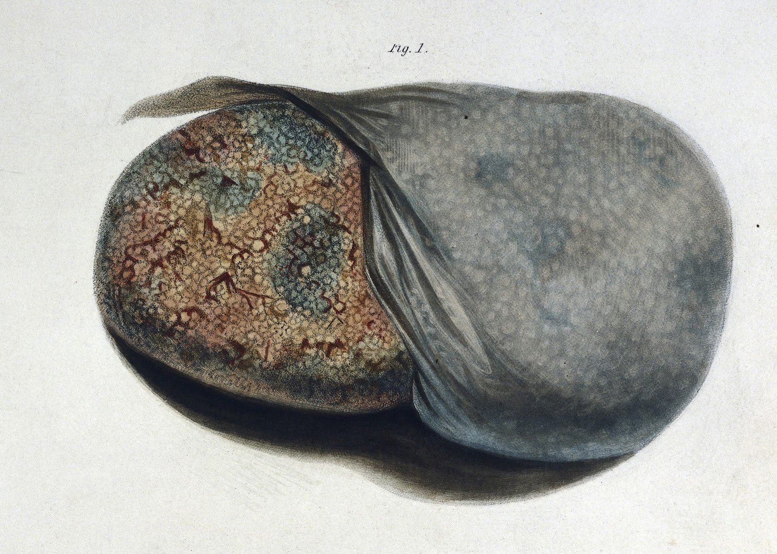 Richard Bright And The Discovery Of Kidney Disease History Of Nephrology richard-bright-and-the-discovery-of-kidney-disease-history-of-nephrology
