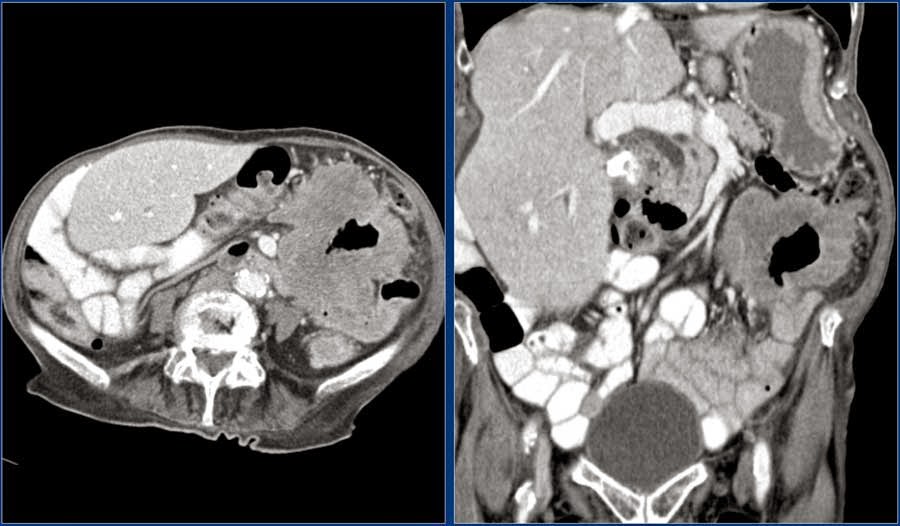 Small Bowel Aneurysmal Dilatation Differential Diagnosis Radiology small-bowel-aneurysmal-dilatation-differential-diagnosis-radiology