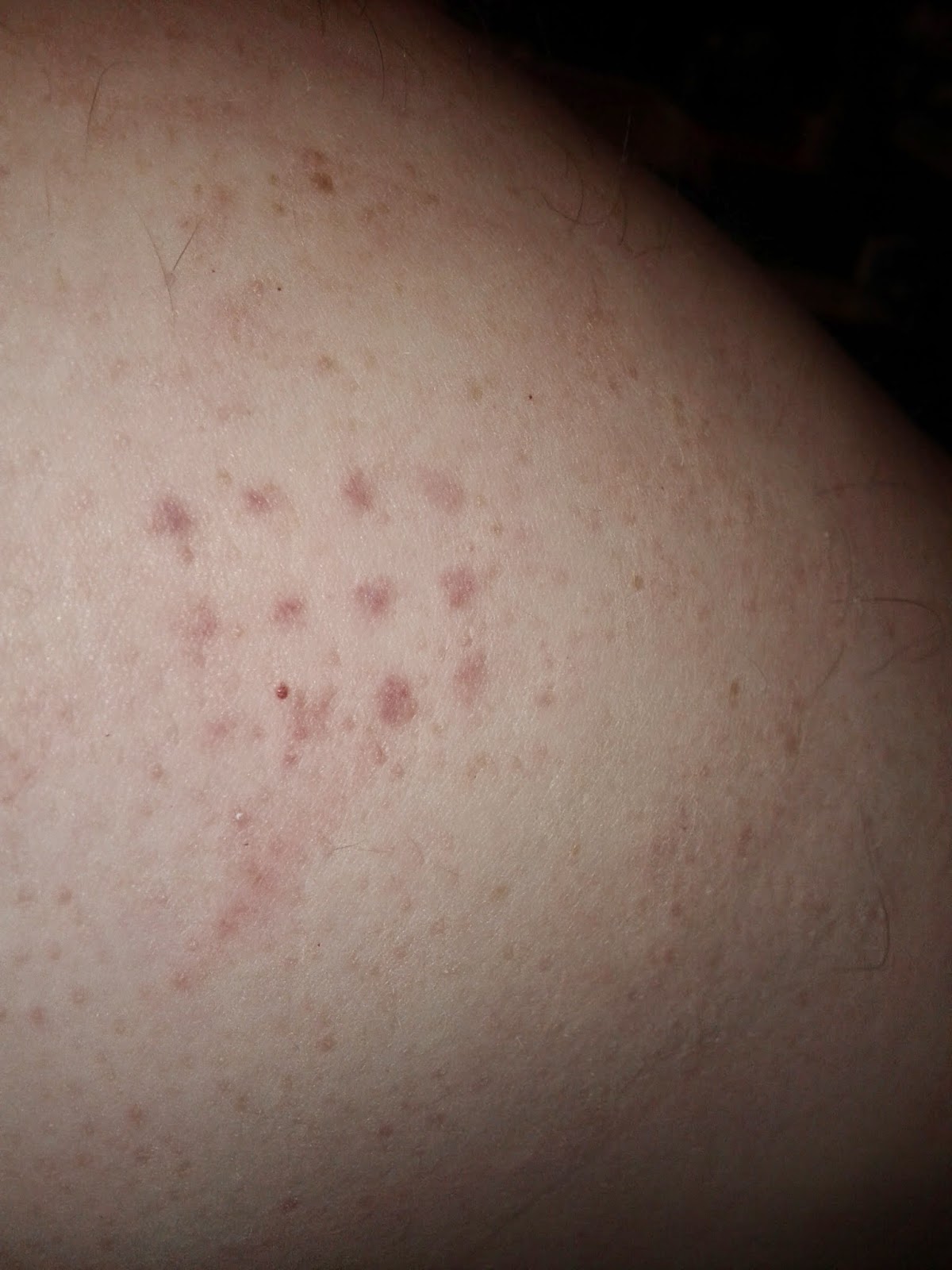Britishcolumbiaufos Alien Abduction Strange Marks On The Body britishcolumbiaufos-alien-abduction-strange-marks-on-the-body