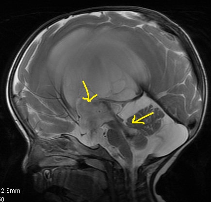 Aqueductal Stenosis MRI - Sumer's Radiology Blog