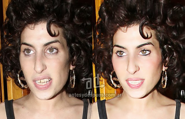 Did Amy Winehouse have Plastic Surgery Before and After Pictures Did Amy Winehouse have Plastic Surgery Before and After Pictures