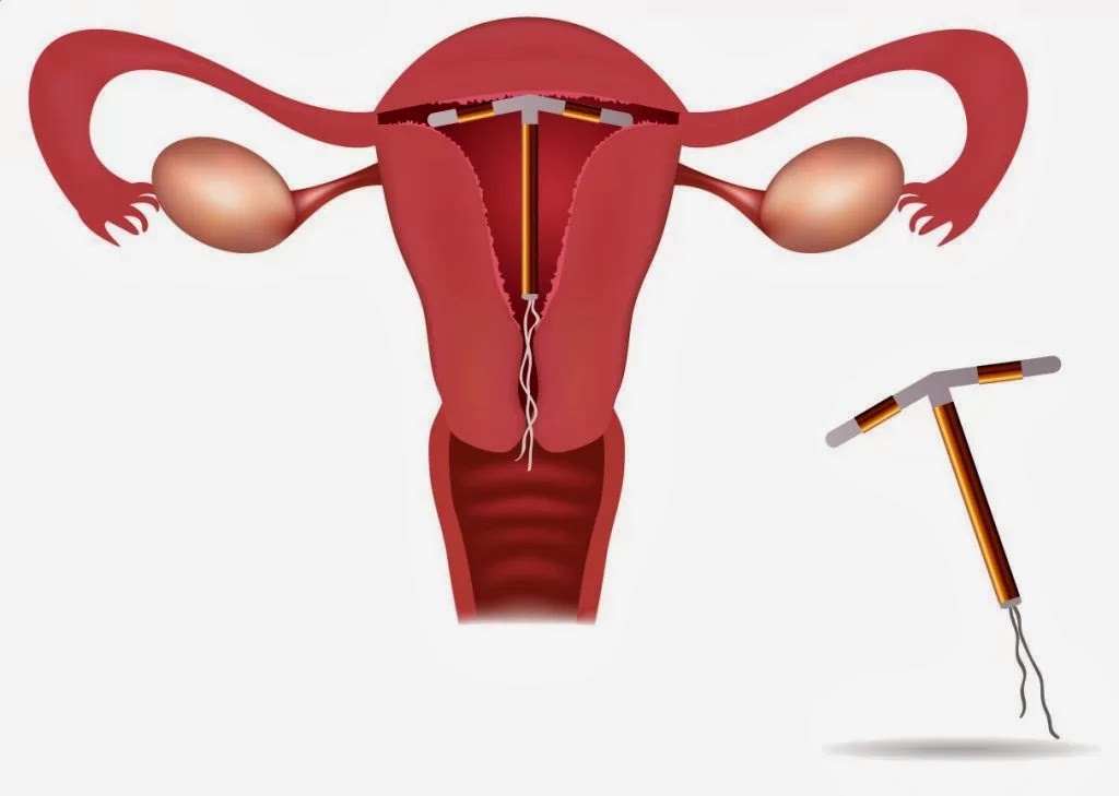 Fakta KB IUD sebagai Alat Kontrasepsi dalam Rahim - Tips Sehat Keluarga Bunda