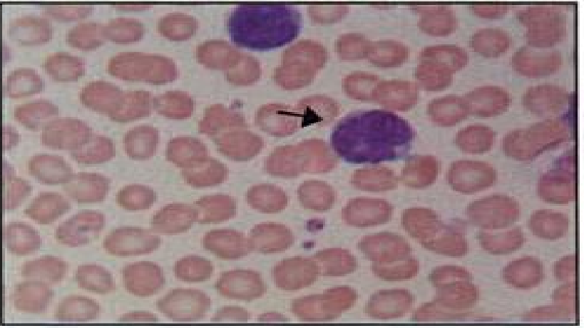 fichero hematologia: Linfoblasto