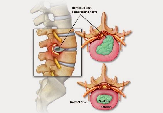 Pengertian Penyakit HNP, Gejala, Penyebab, Pencegahan dan Pengobatan