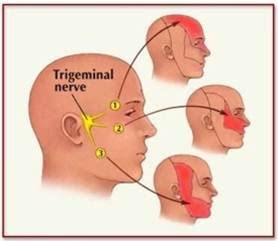 Trigeminal Neuralgia Trigger Points