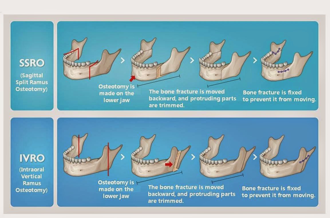 ID Hospital Korea: Before and after underbite jaw surgery at ID Hospital, Korea