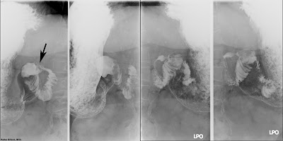 Roentgen Ray Reader: Post Bulbar Duodenal Ulcer