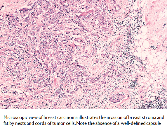 MBBS Medicine (Humanity First): Neoplasia MBBS Medicine (Humanity First): Neoplasia