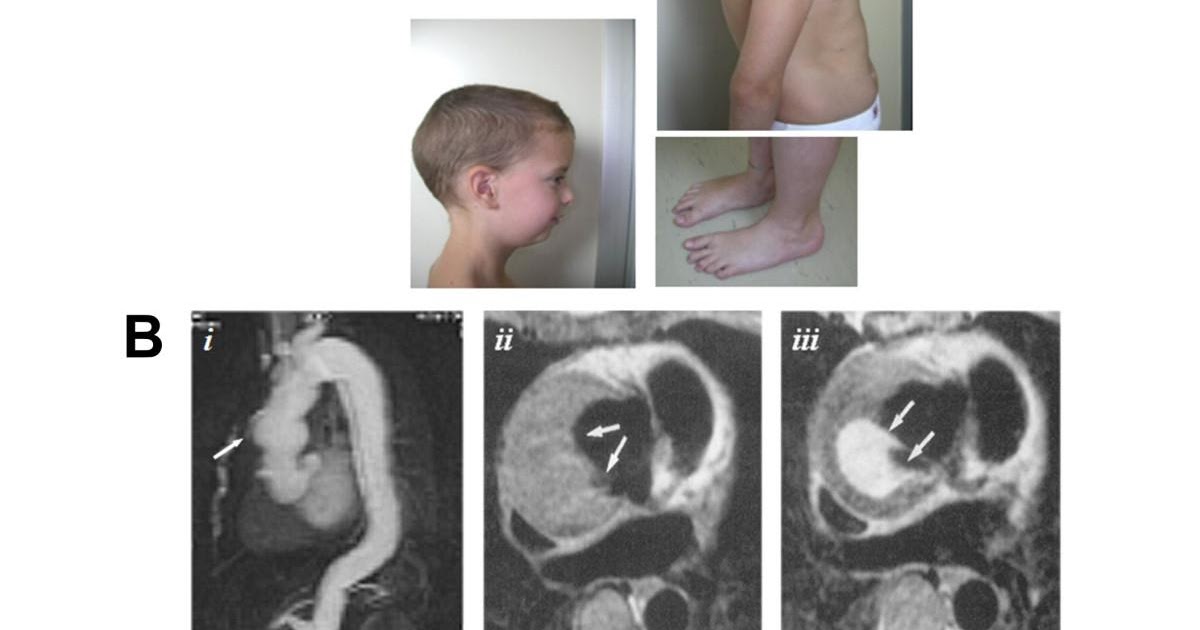 A HUB FOR EVERYONE: Loeys-Dietz syndrome