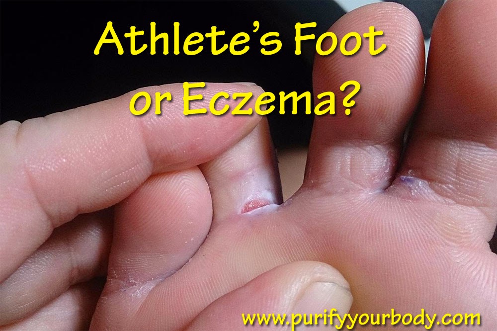 Purify Your Body Detox Foot Pads Athlete s Foot Or Eczema purify-your-body-detox-foot-pads-athlete-s-foot-or-eczema