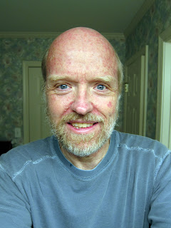 Efudex - Round Two: Day 9 - Starting to Feel the Burn