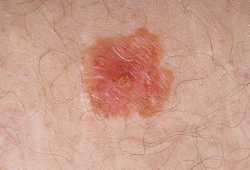 Pictures Of Skin Cancer Basal Cell Carcinoma Skin Cancer pictures-of-skin-cancer-basal-cell-carcinoma-skin-cancer