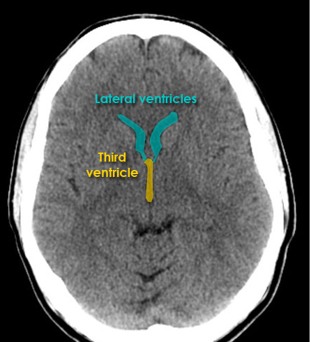 3rd Ventricle Anatomy - vrogue.co