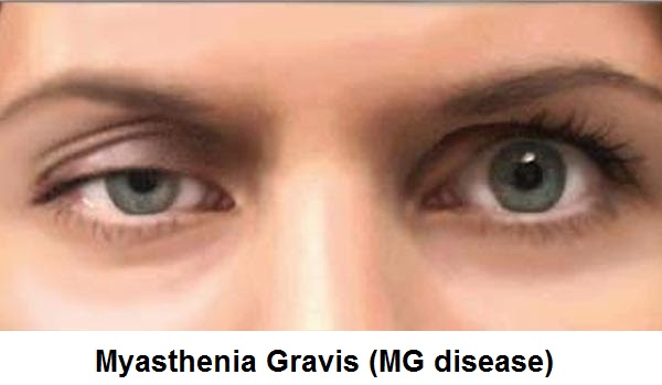 Nurse Health Guides : Myasthenia Gravis (MG Disease): Signs-Symptoms ... Nurse Health Guides : Myasthenia Gravis (MG Disease): Signs-Symptoms ...