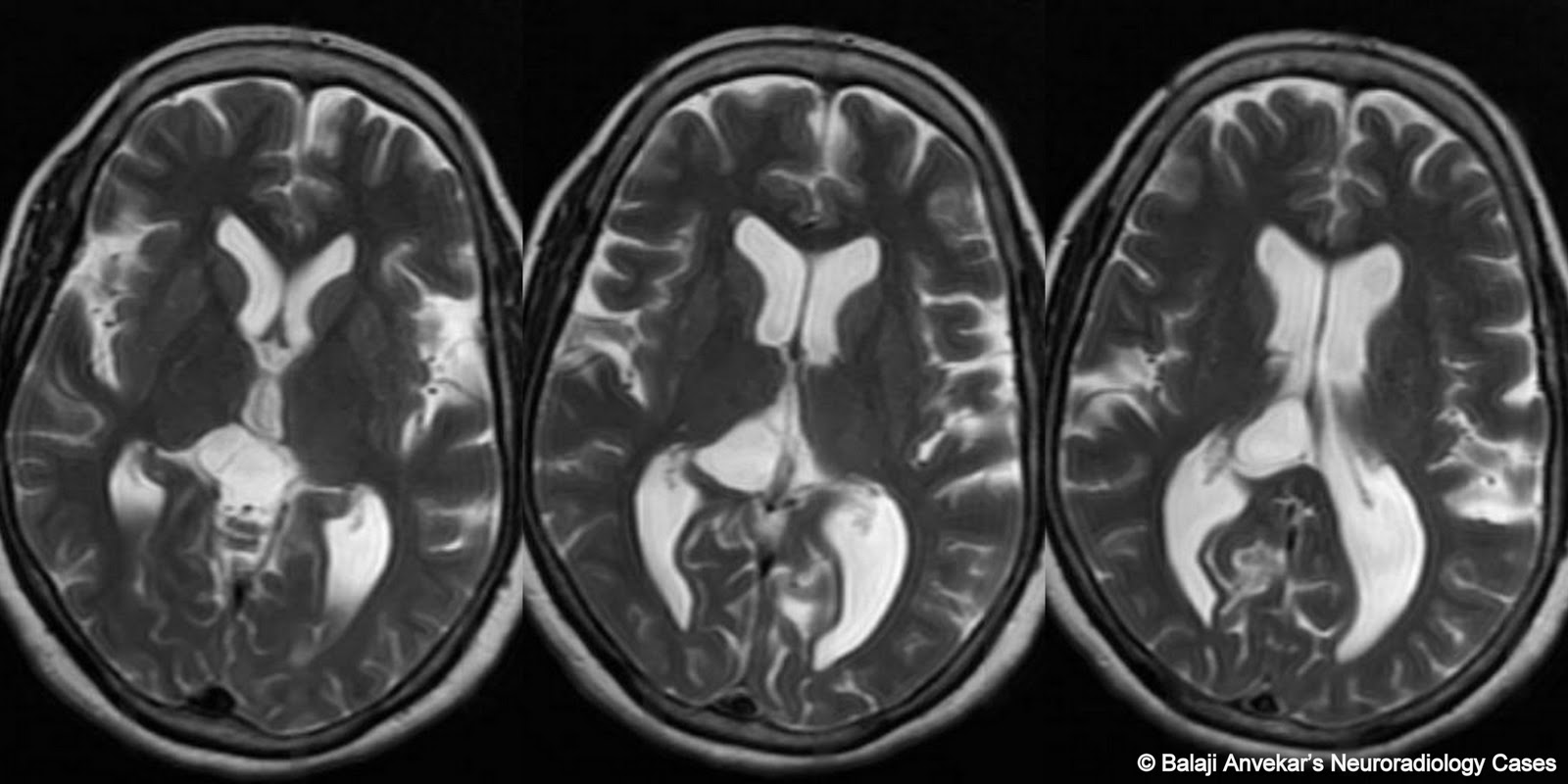 Dr Balaji Anvekar FRCR Ependymal Cyst MRI dr-balaji-anvekar-frcr-ependymal-cyst-mri