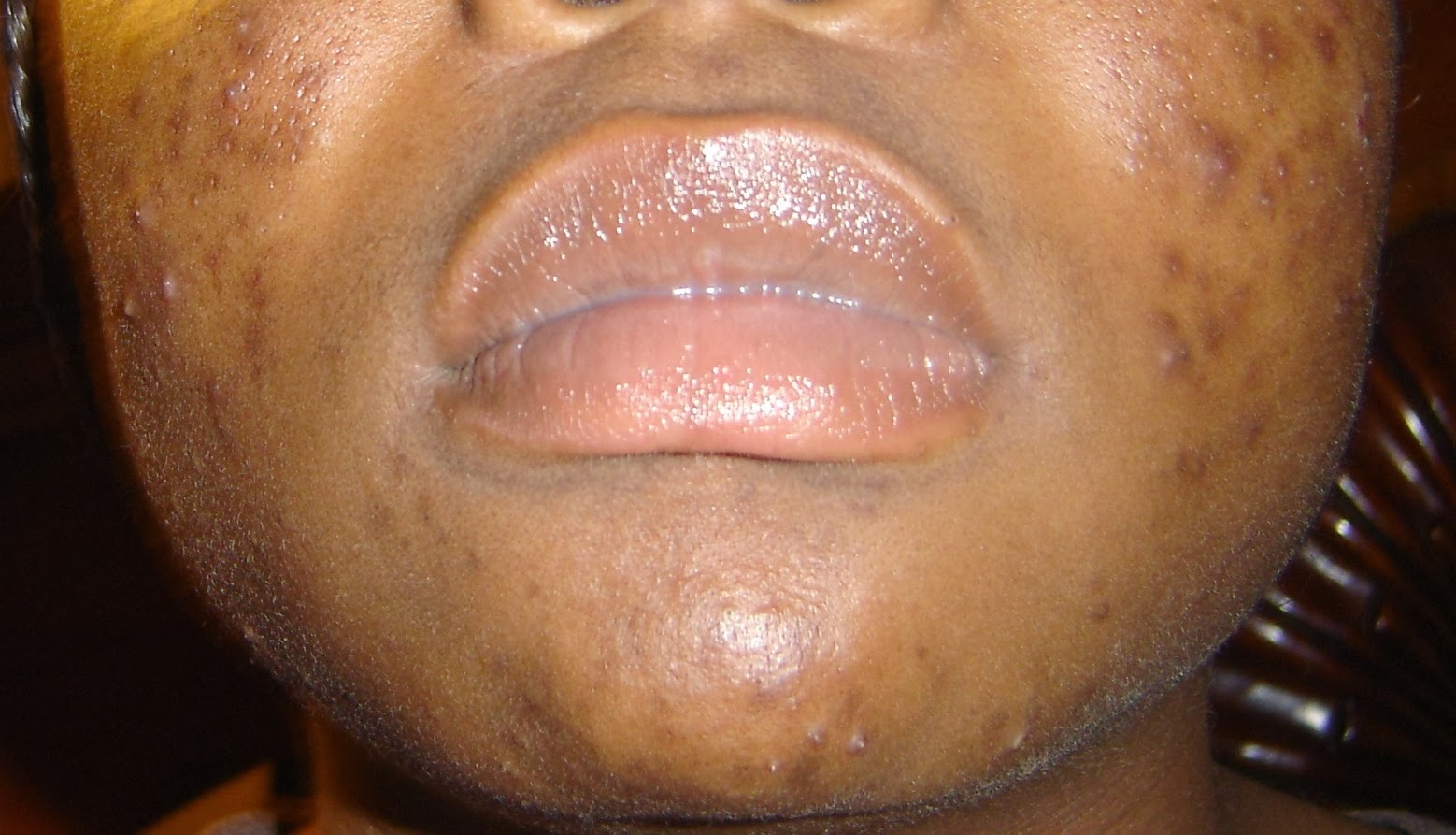 The Life Of A 20 Something With Lupus Maintaining Clear Skin Discount the-life-of-a-20-something-with-lupus-maintaining-clear-skin-discount