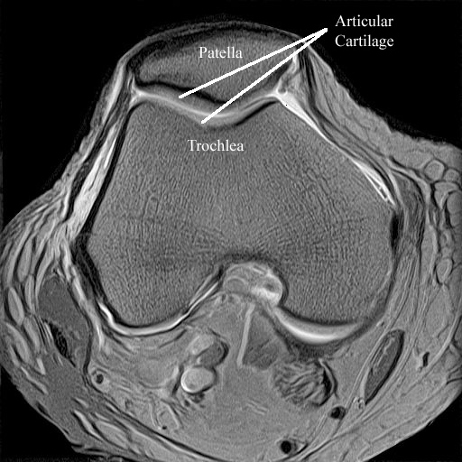 Mri Anatomy Of Knee Joint Radiology at Harrison Trethowan blog