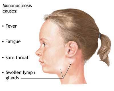 Mononucleosis Symptoms - Healthy future