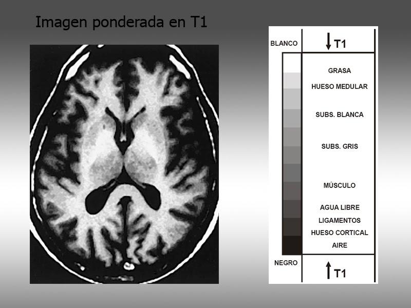 Resonancia Magnética de cerebro: Imágenes ponderadas en T1 Resonancia Magnética de cerebro: Imágenes ponderadas en T1