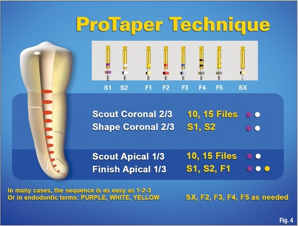 The Endo Files: ProTaper Technique