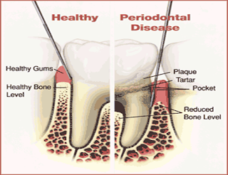 Sherman Oaks Dentist: Understanding Periodontal Disease