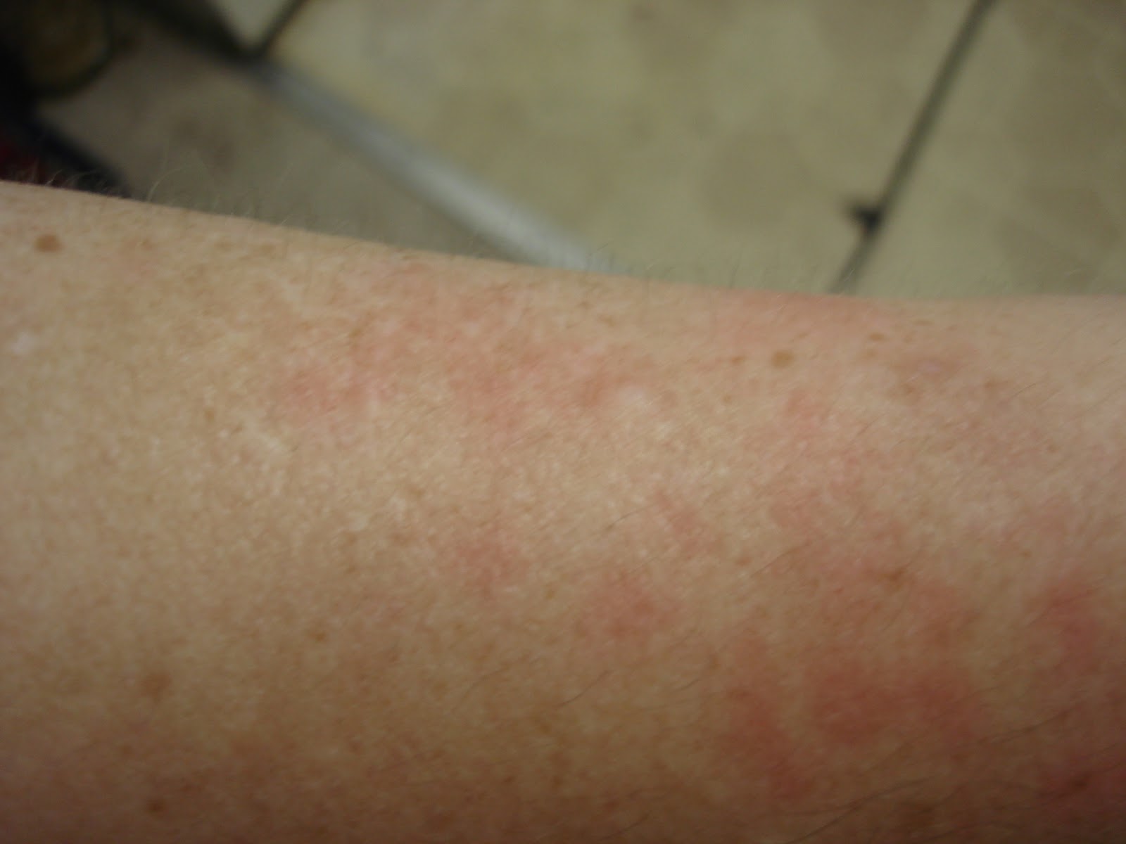 As My Fibro World Turns Red Thick Scaly Rash Photos as-my-fibro-world-turns-red-thick-scaly-rash-photos