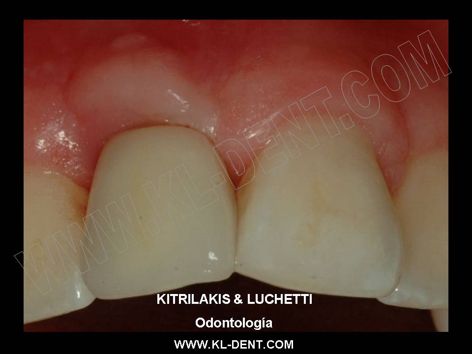Kitrilakis & Luchetti - Dentistry: Dental Implant in Upper Central ... Kitrilakis & Luchetti - Dentistry: Dental Implant in Upper Central ...
