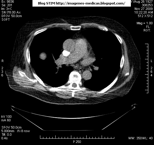 Sobre técnicas de imágenes médicas (Blog STIM): Tromboembolismo Pulmonar (TEP) y Tc multicorte ...