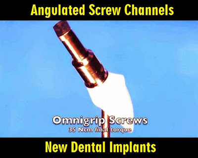 IMPLANTOLOGY: New Dental Implants - Angulated Screw Channels - Odonto-Tv